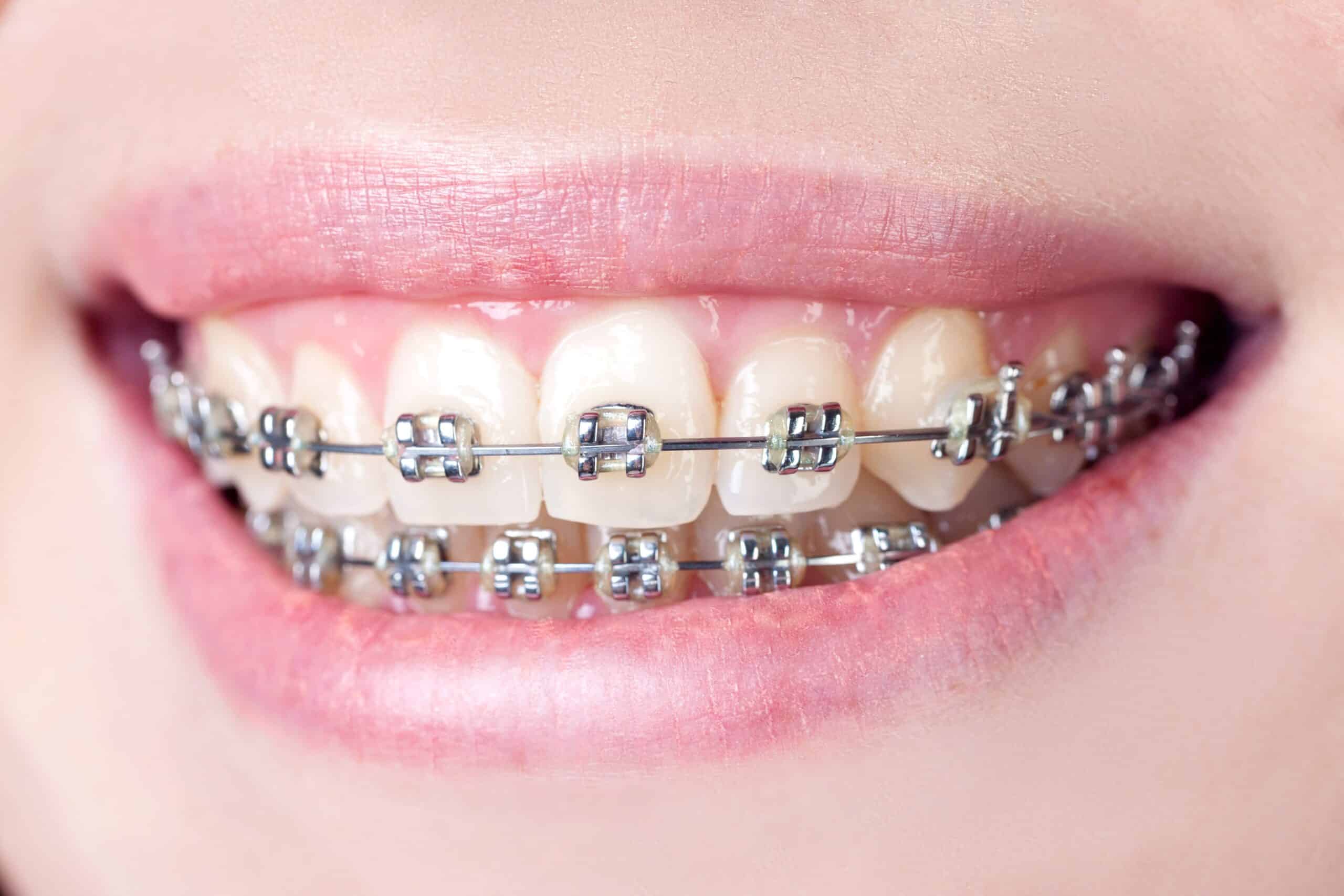 Are Traditional Braces Still the Best Option for Complex Cases? Expert ...
